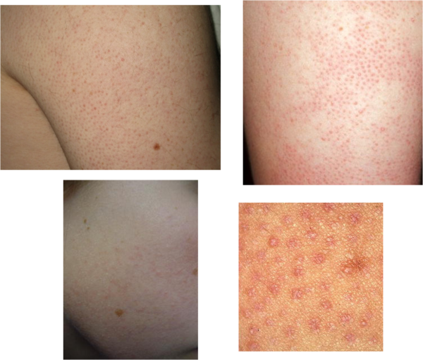 Do you have Bumps on your Arms? …maybe it’s Keratosis Pilaris ...